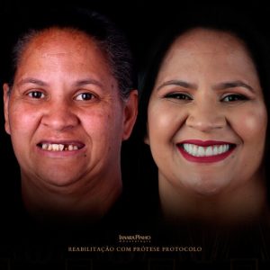 Prótese Protocolo: o que é, como funciona e seus benefícios